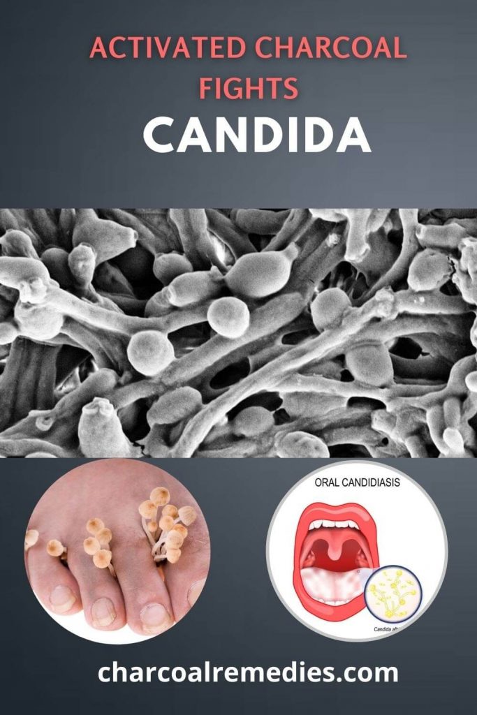 Natural Candidiasis Treatment - Charcoal Remedies