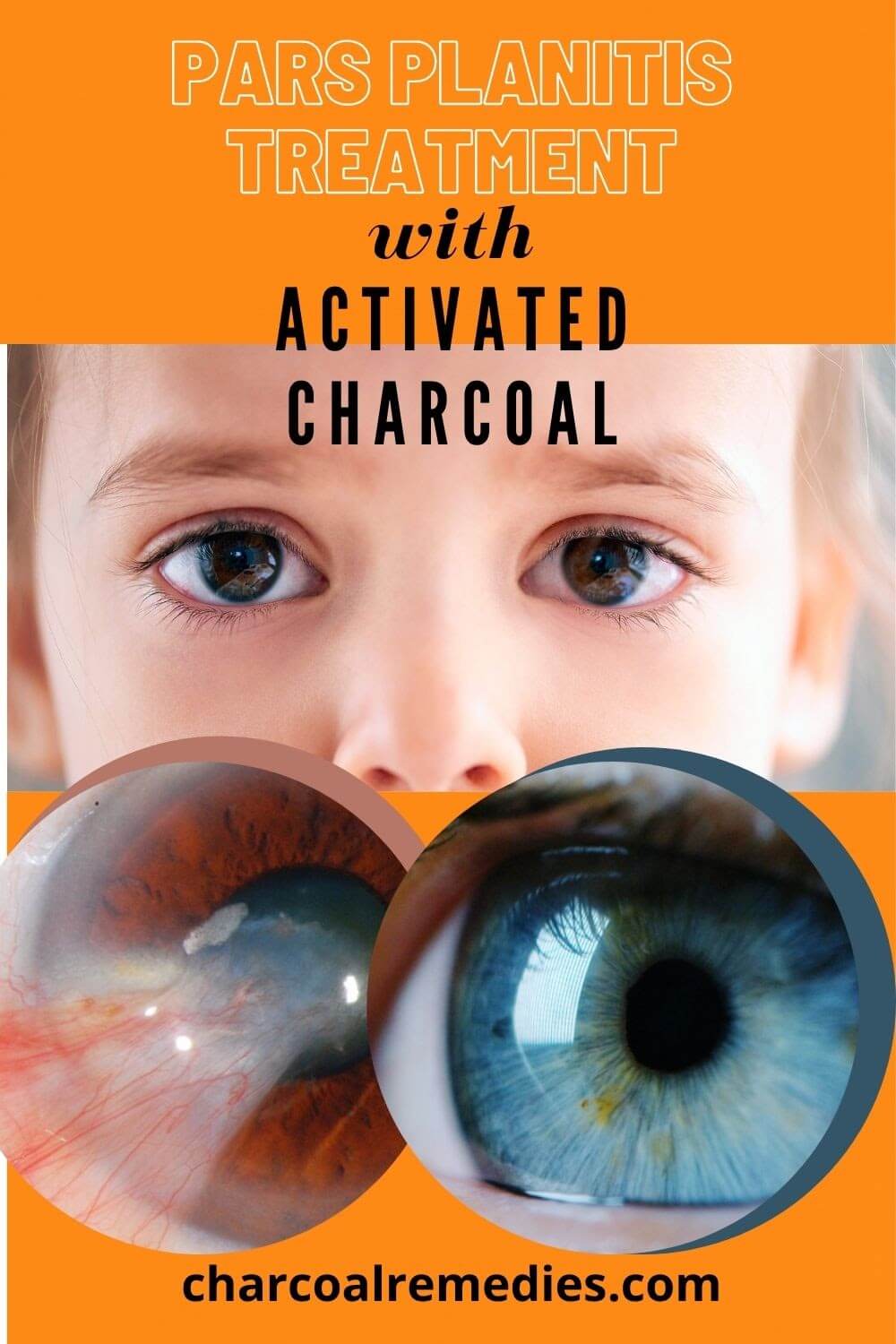 Pars Planitis – Charcoal Remedies