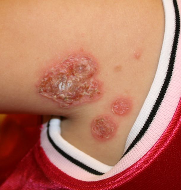 MRSA – Charcoal Remedies